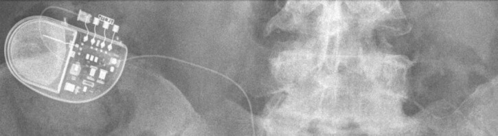 WaveWriter Alpha | Spinal Cord Stimulation | BLB Solicitors